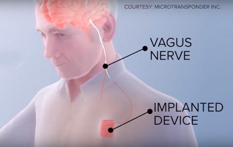 Neurostimulation Implant Helps Stroke Patients Recover Faster SlashGear