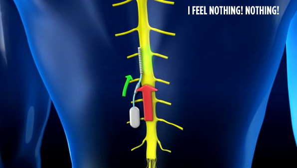 Electronic Chip to Block Pain Signals Being Developed in Australia ...