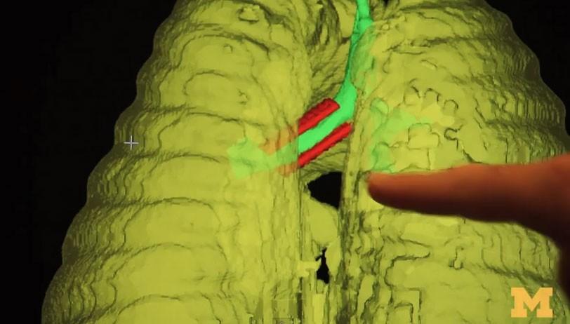 3D-printed splint keeps babies breathing - SlashGear