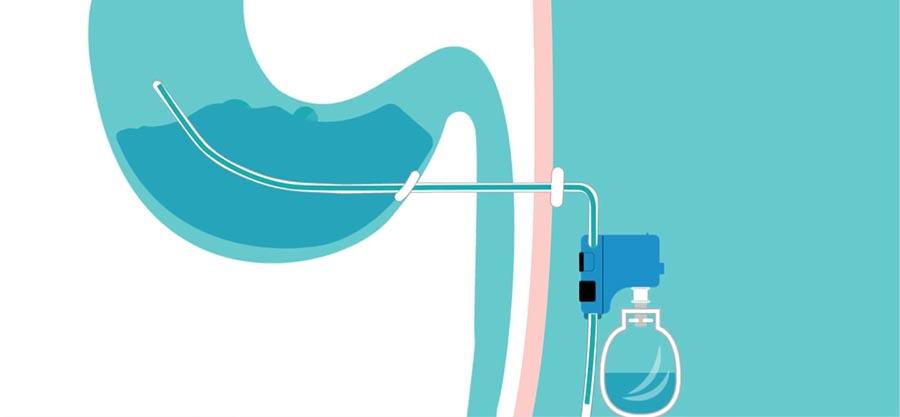 FDA approves home stomach pump to combat obesity - SlashGear