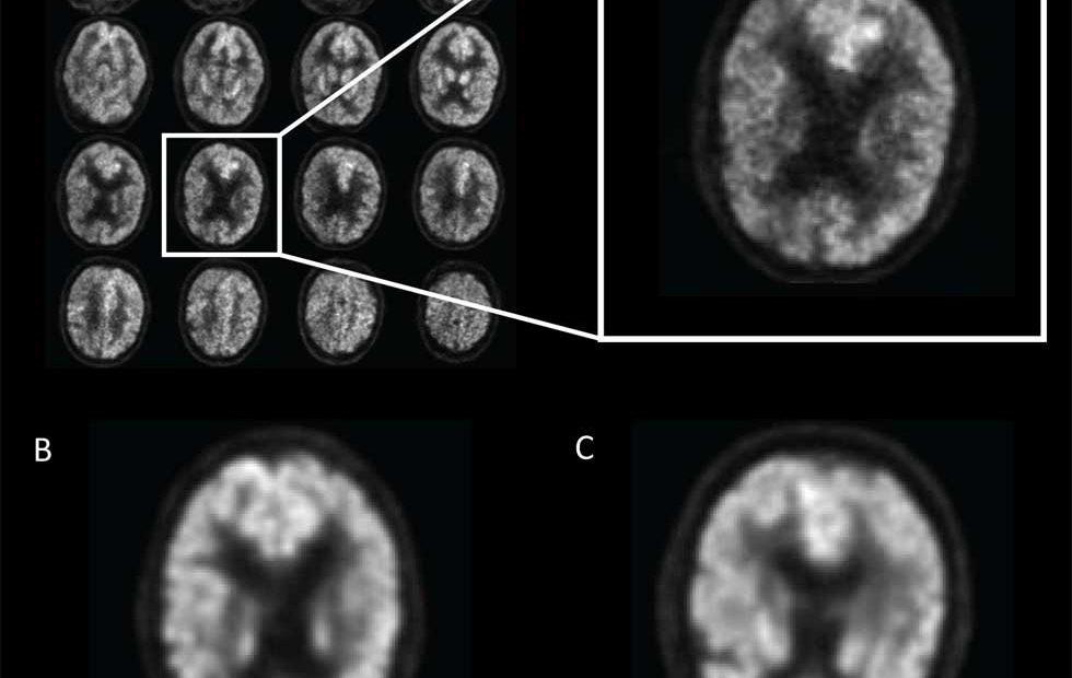 Deep Learning AI diagnosed Alzheimer's 6-years earlier than ... Deep Learning AI diagnosed Alzheimer's 6-years earlier than ...