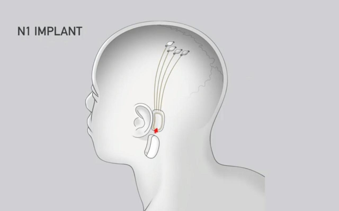 Elon Musk's Neuralink will put tiny threads in brains to control ...